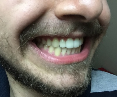 Is it normal to have different colored teeth? How to even their colors