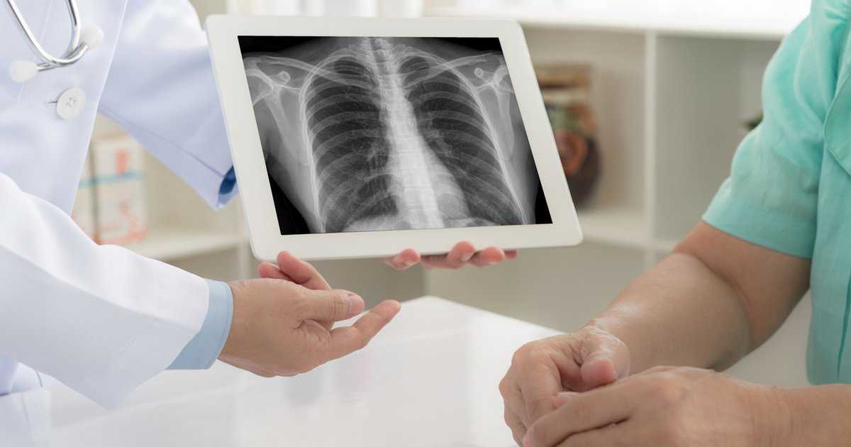 What to know about funnel chest (pectus excavatum) by University Ci...