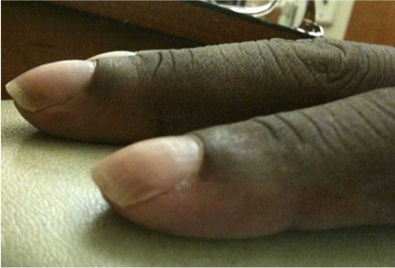 15 Fingernail and Toenail Abnormalities by Tasc Inc